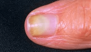 Yellow Toenails-Know Details of it and Get Some Remedies!